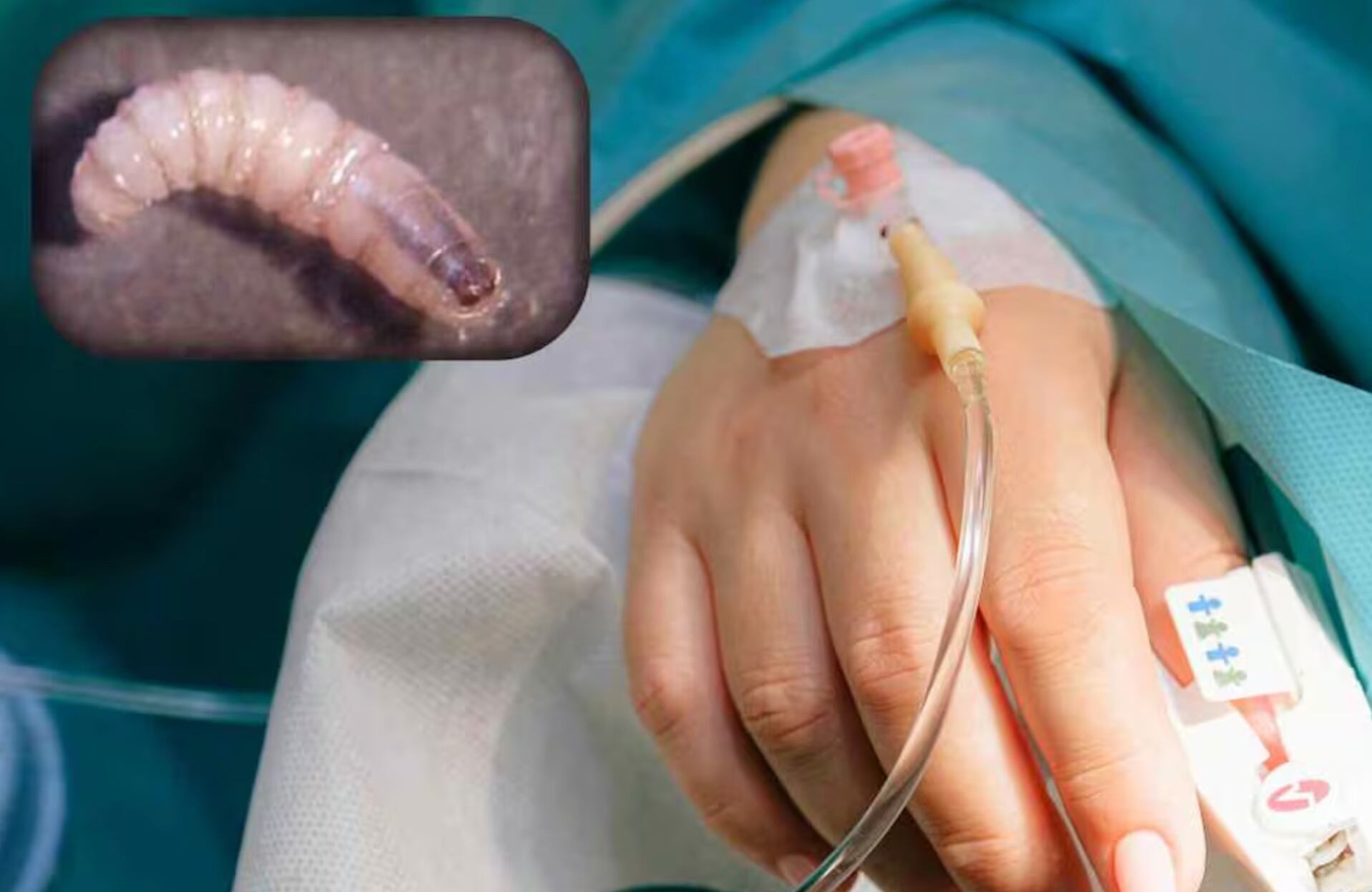 Ssa: México registra 31 casos de miasis por gusano barrenador en humanos; 29 están en Chiapas ...